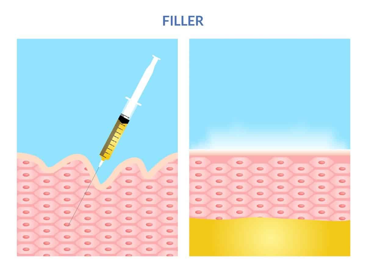 Best Treatments for Acne Scars